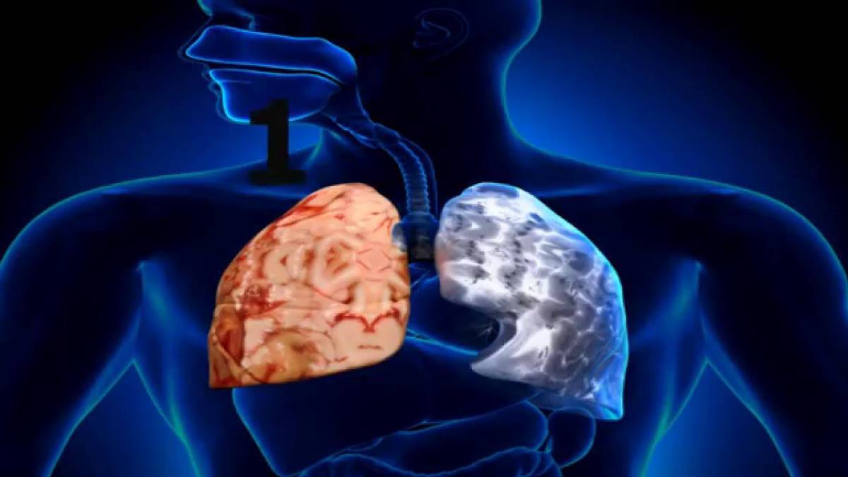 Fabrican un nuevo inhalador para pacientes con EPOC - AS.com