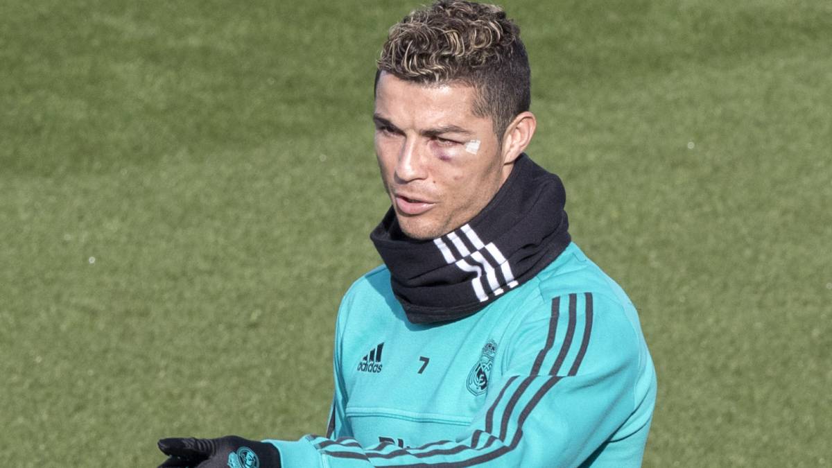 Cristiano Ronaldo | Ronaldo black eye the focus of attention as Real ...